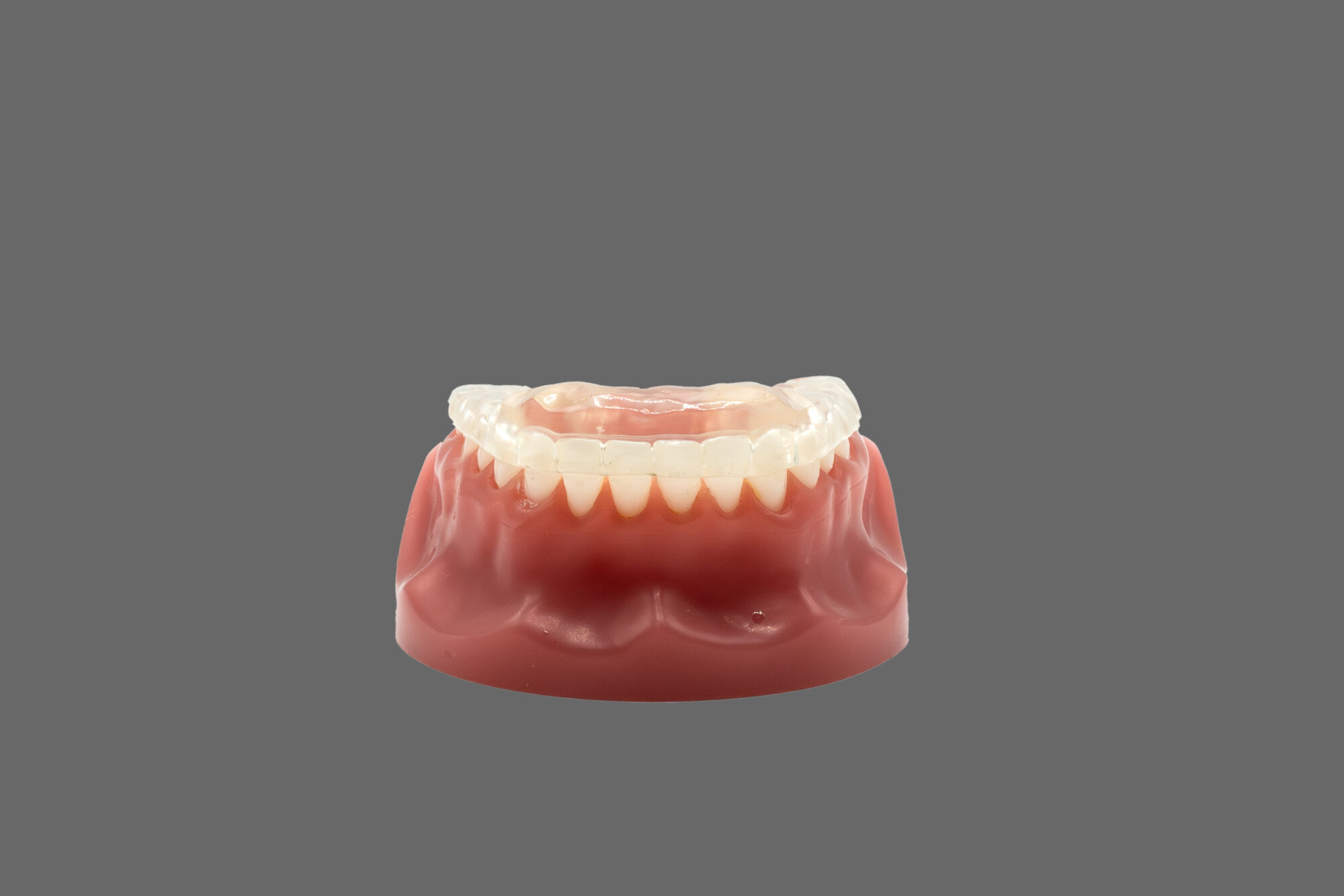 Occlusal Splints - Cardiff Ortho